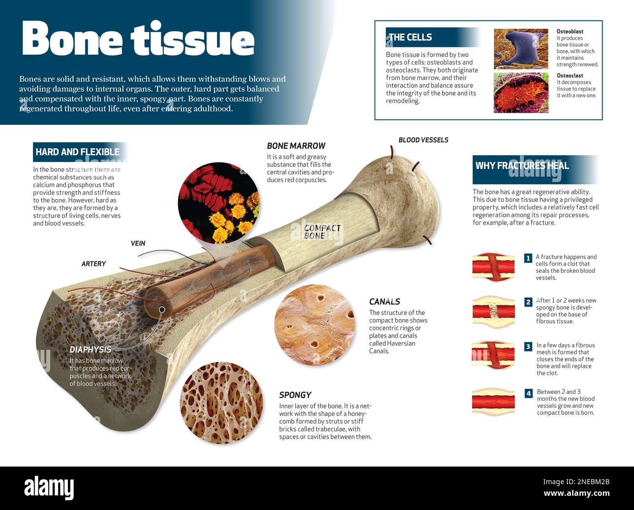 Infography on bone tissue. Bone structure and detail of why fractures ...