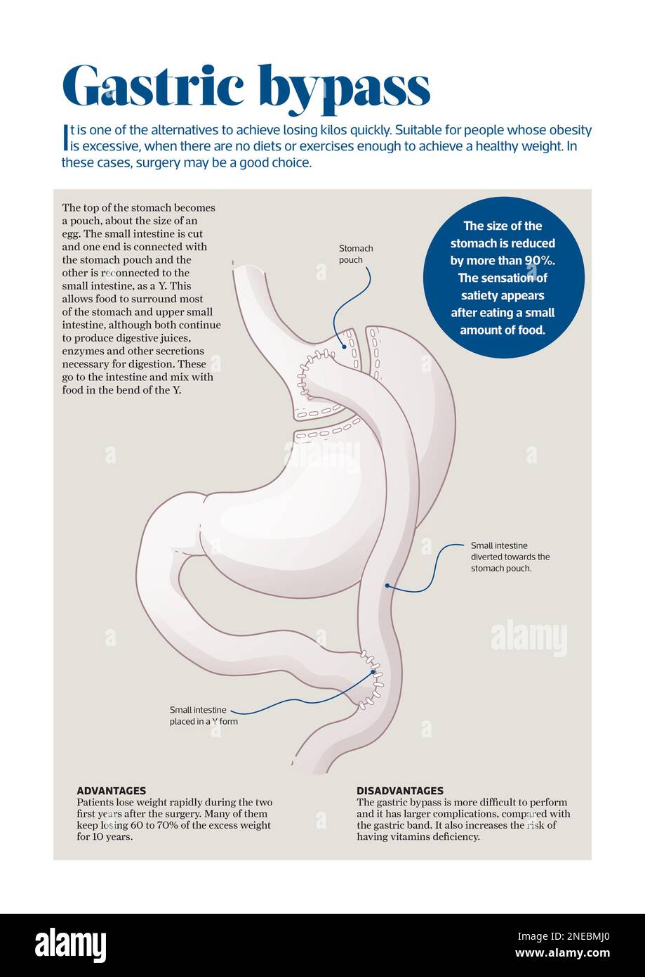 Infographic That Explains What The Gastric Bypass Surgical Procedure Is
