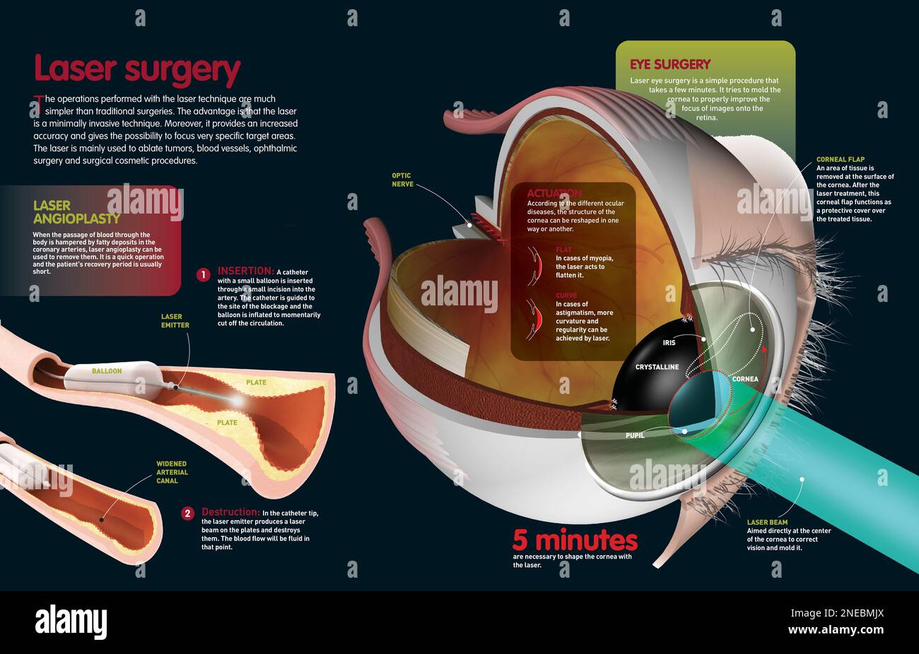 Infographic that describes laser surgery applications, adequate for ...
