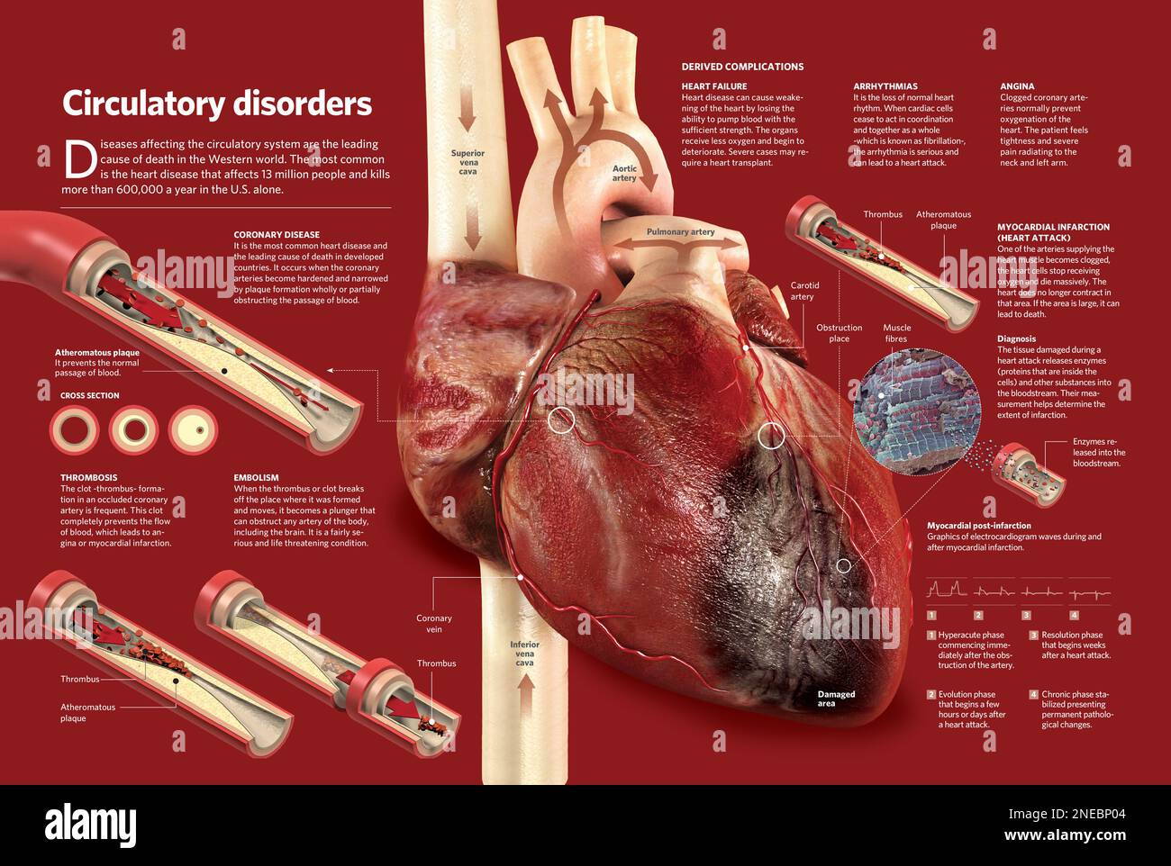 Infographic about a number of diseases affecting the circulatory system ...