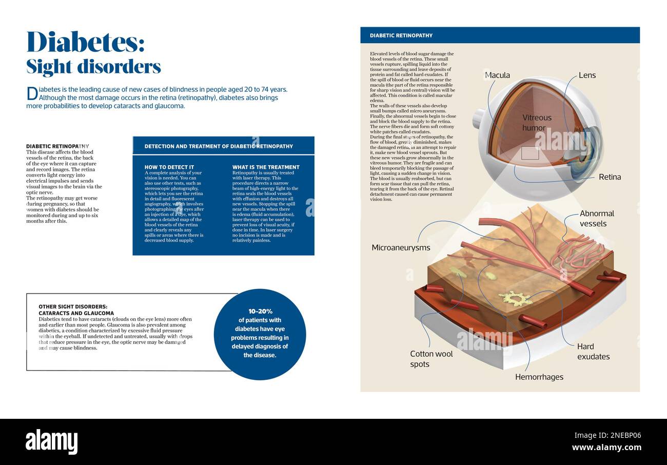 Infographic about the sight diseases that can arise from diabetes ...