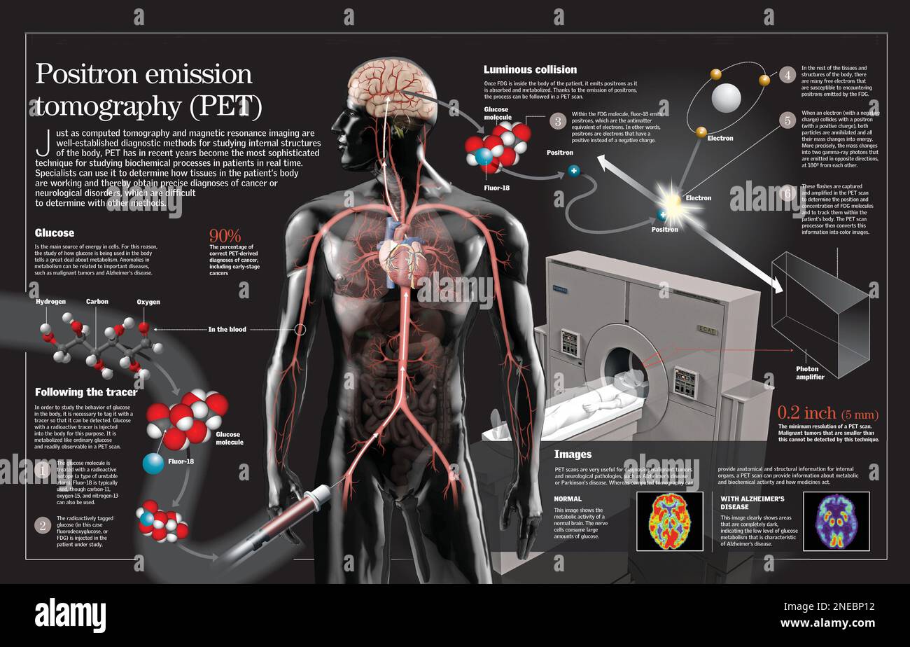 Infographic of the positron emission tomography (PET), a technique that ...