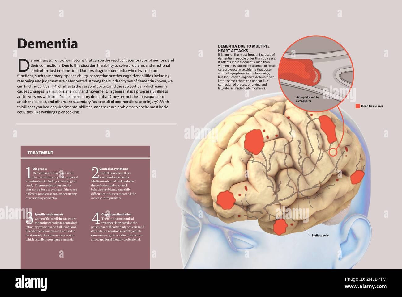 Infographic about dementia, a progressive and irreversible ...