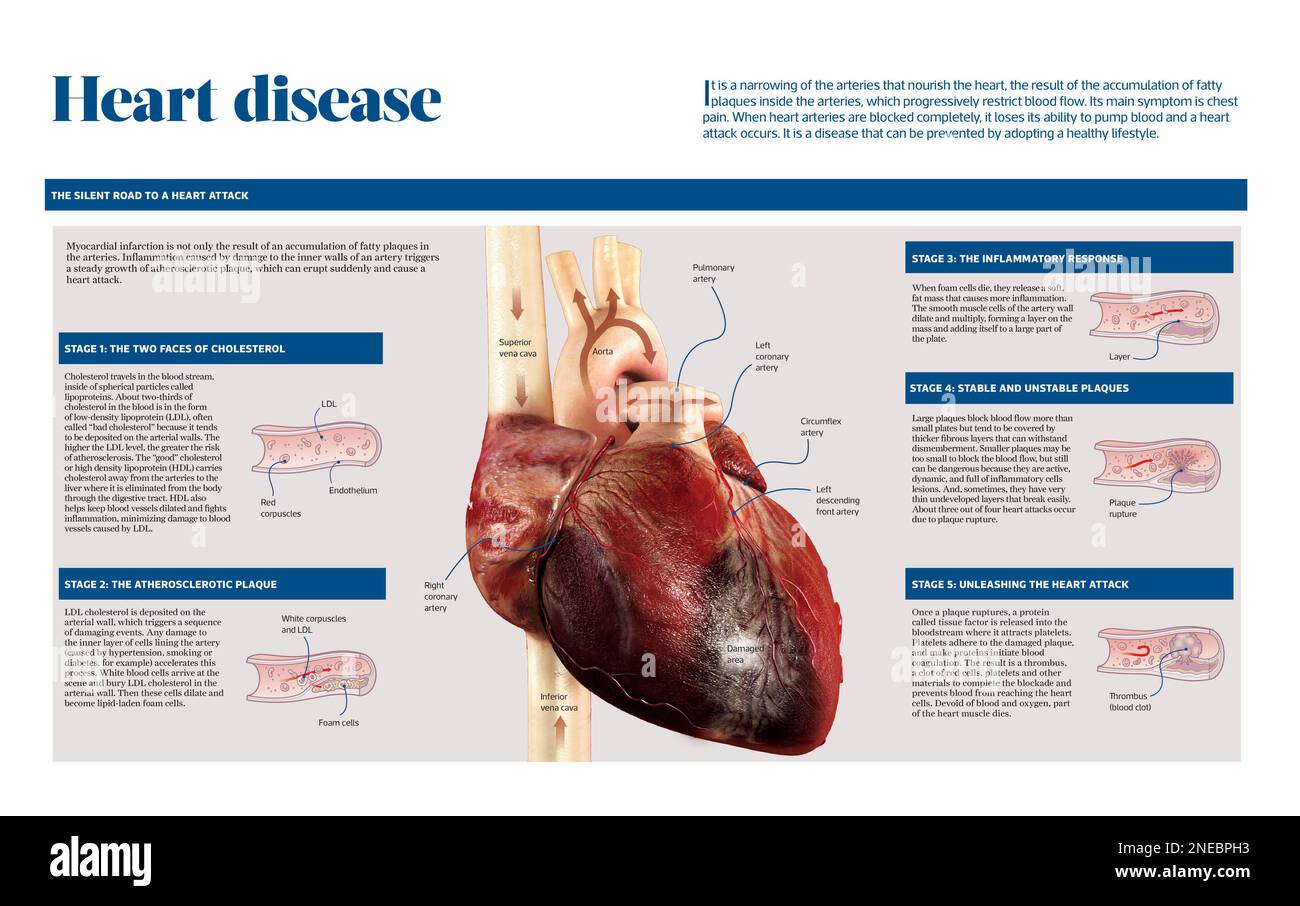 Infographic about heart or cardiovascular disease, showing the steps ...