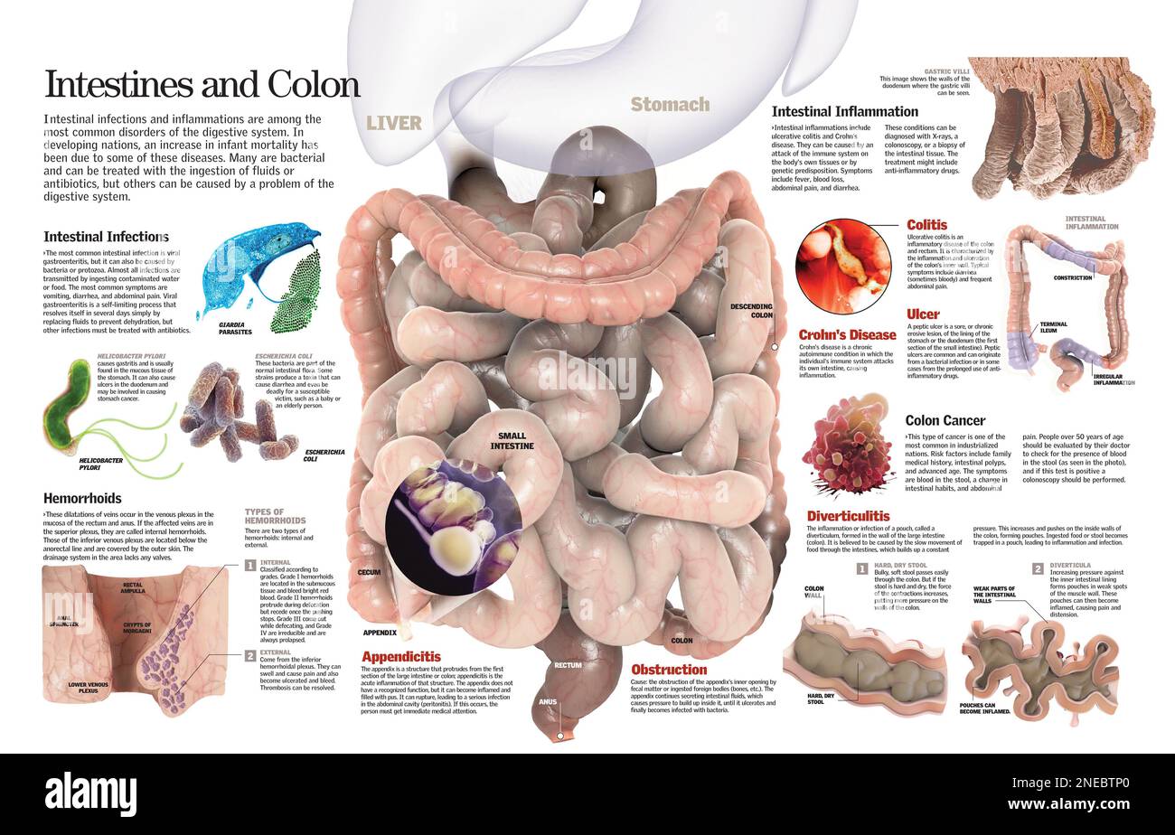 Infographic of the most common illnesses of the colon and intestine ...