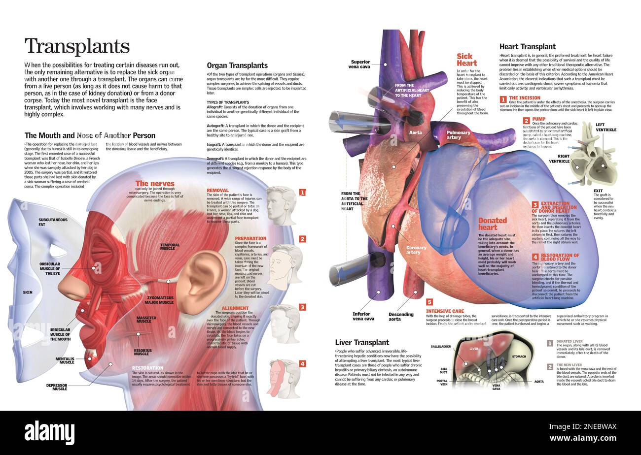 Infographic of the procedure involved in conducting transplants of the ...