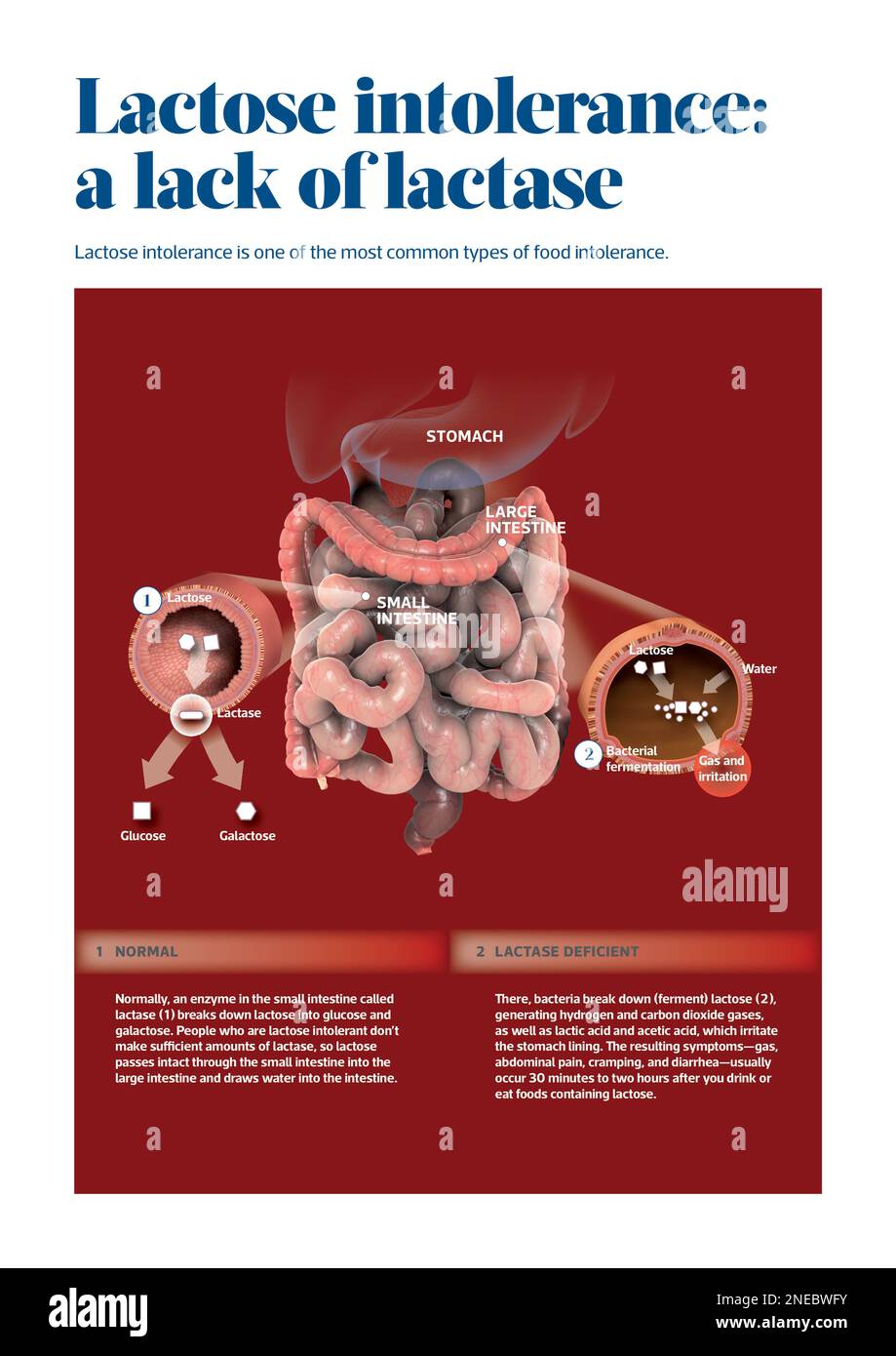 Infographic About Lactose Intolerance One Of The Most Common Types Of Intolerance To Food
