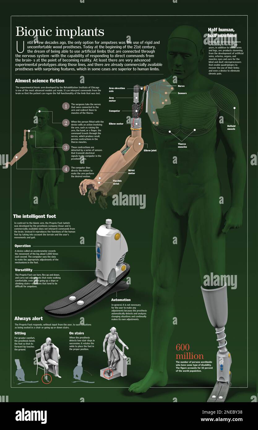 Infographic about bionic implants, a solution for those people with ...