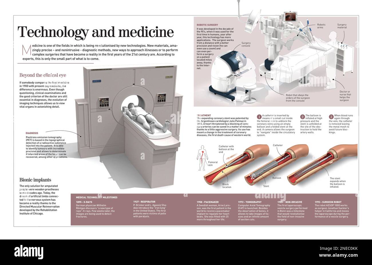 Expanding heart stent hi-res stock photography and images - Alamy
