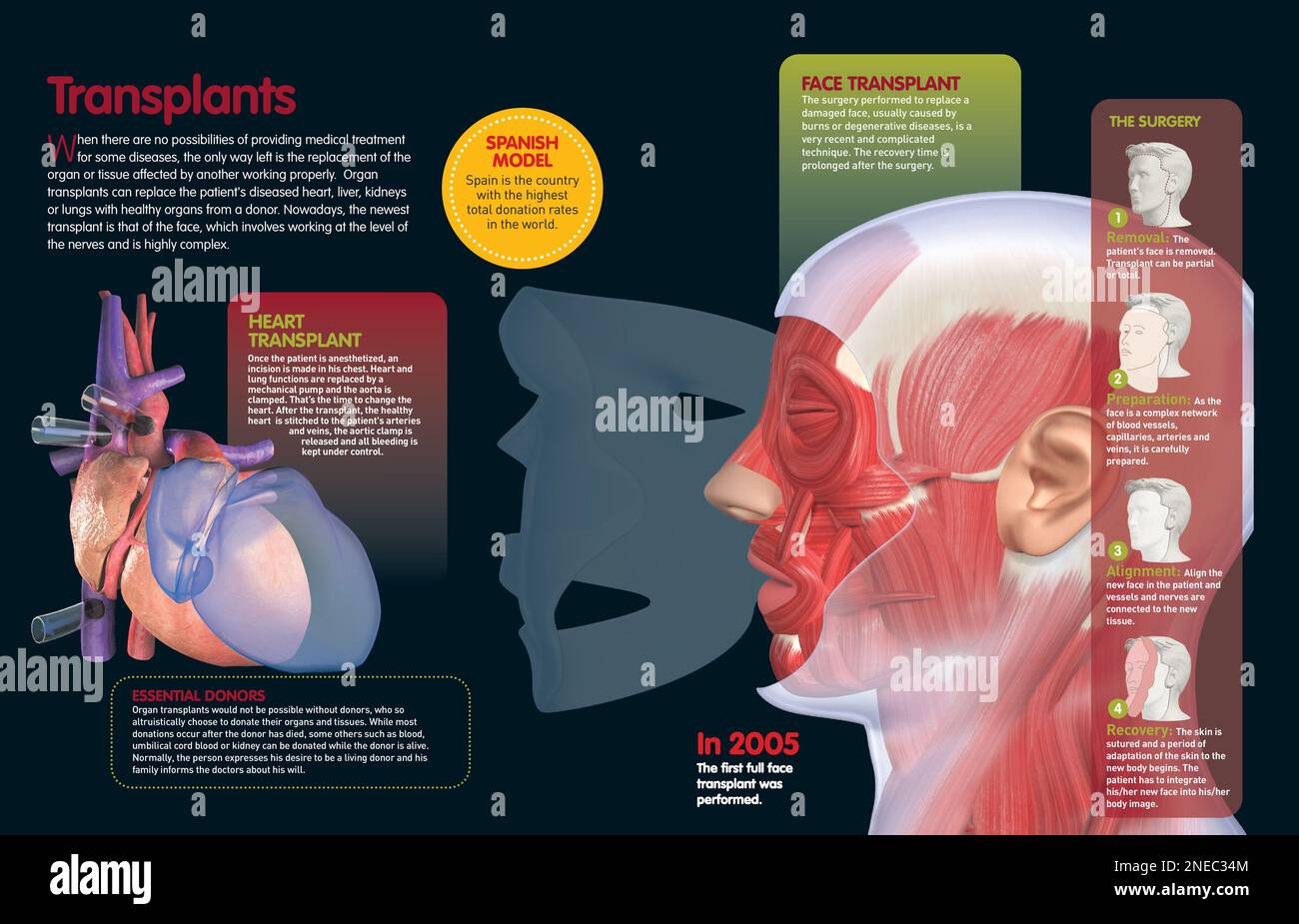 Infographic about organs transplants, especially face transplant, done ...
