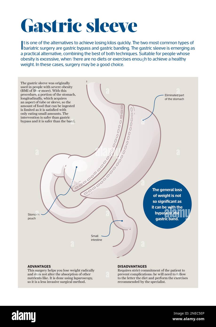 Infographic that explains what the gastric sleeve surgery technique is ...