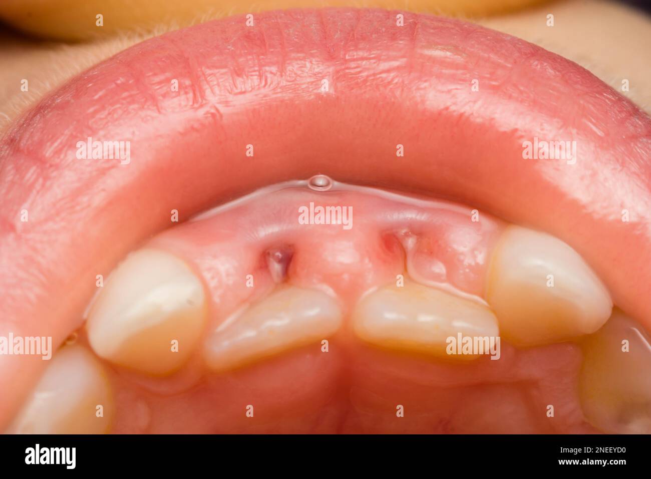 child mouth after deciduous teeth extraction Stock Photo - Alamy