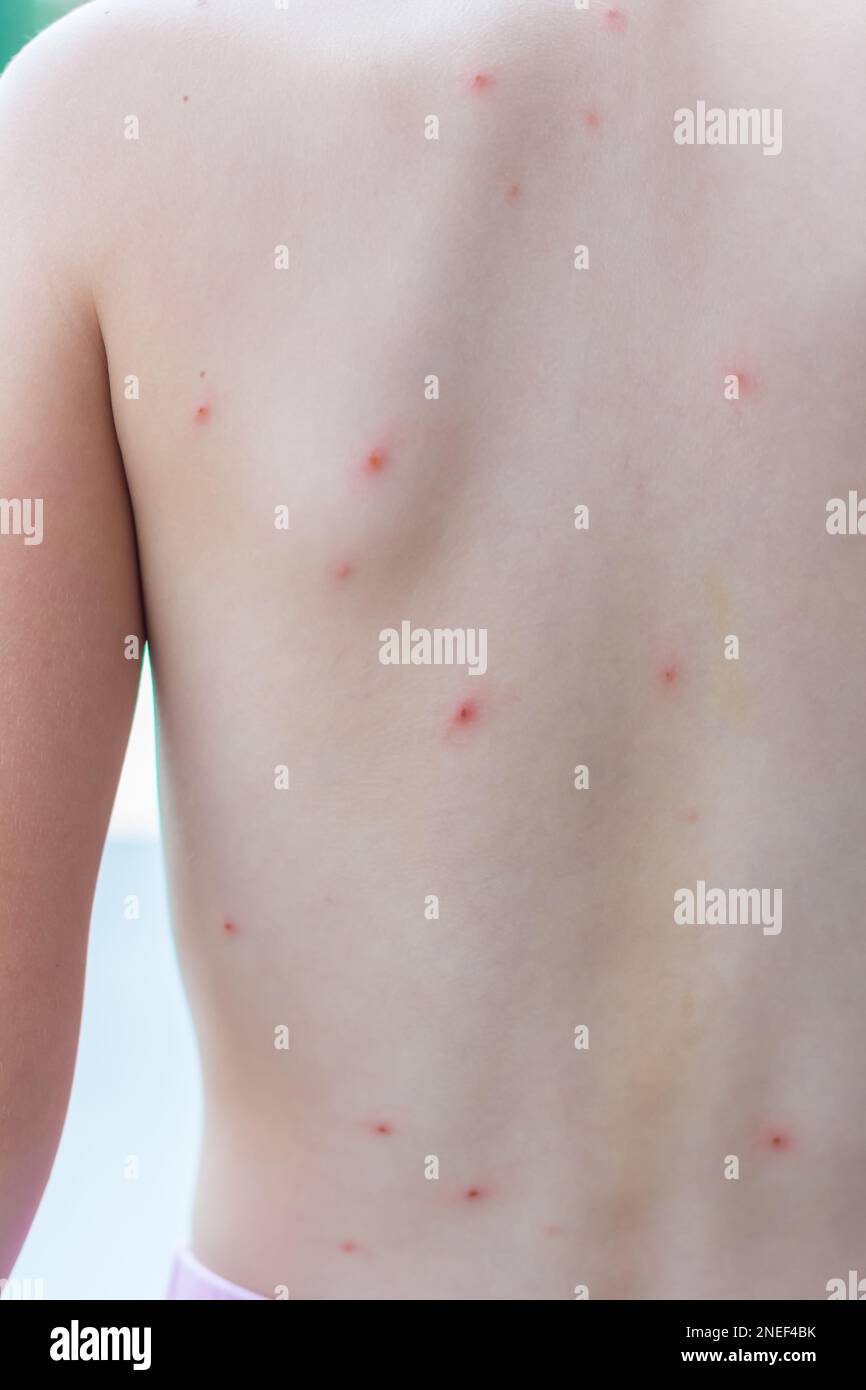 Child illness skin rash epidemic hi-res stock photography and images - Alamy