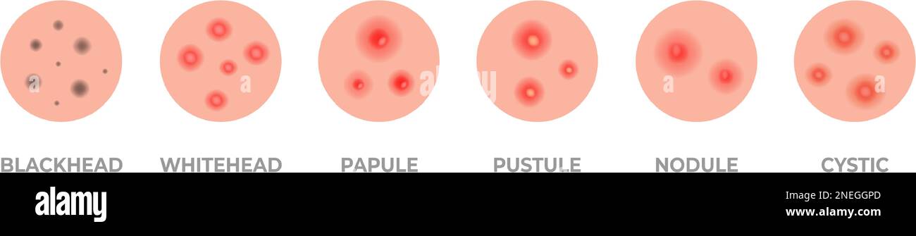 Acne Types Set Skin Pimples Blackheads And Face Comedones Acne Skin