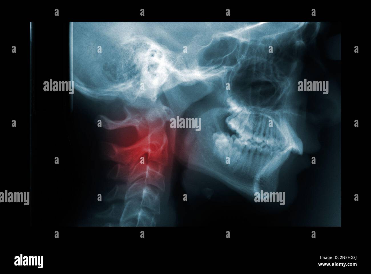 X-ray of the cervical spine painful area Stock Photo - Alamy