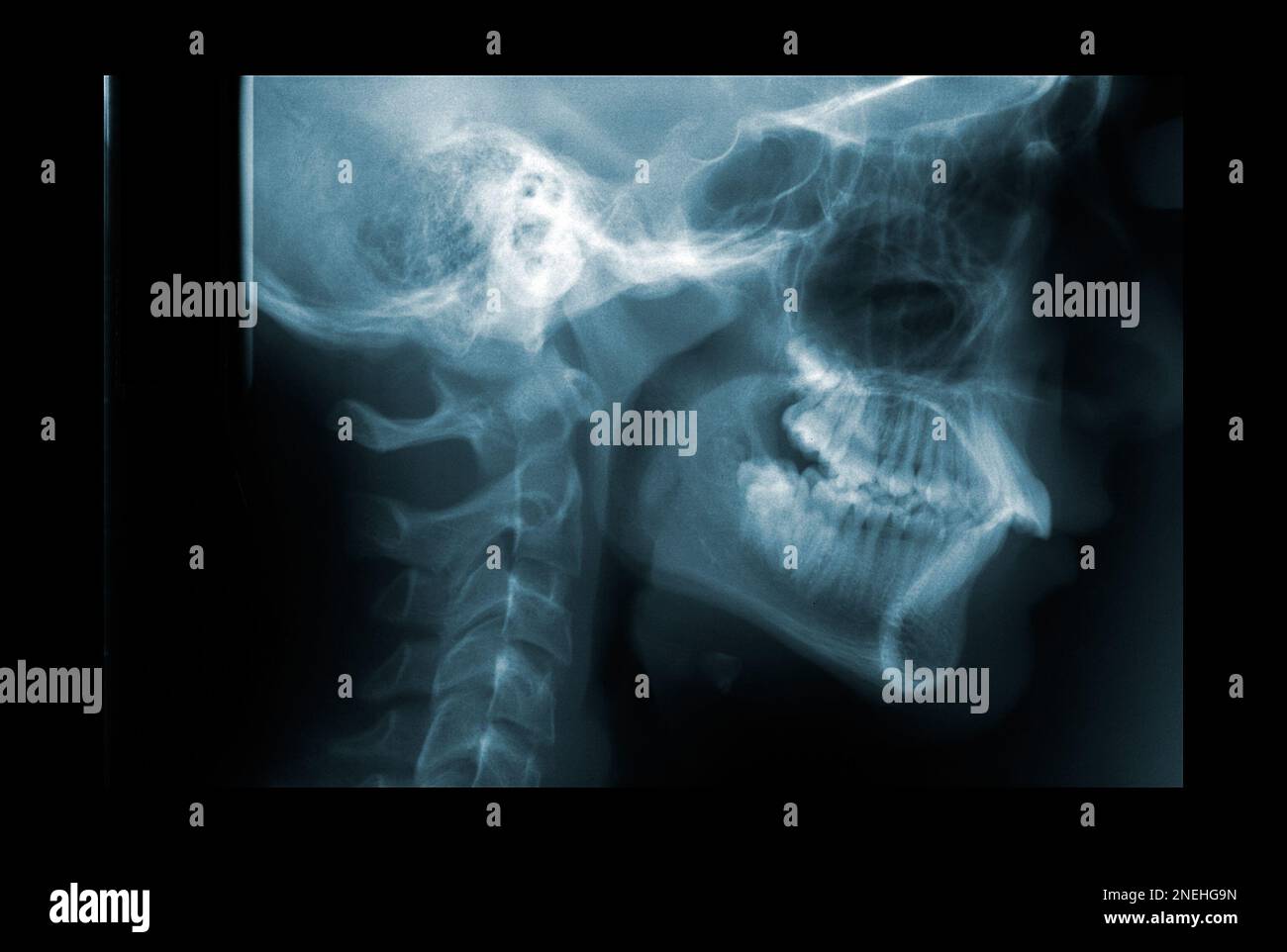 Cervical vertebrae cancer hi-res stock photography and images - Alamy