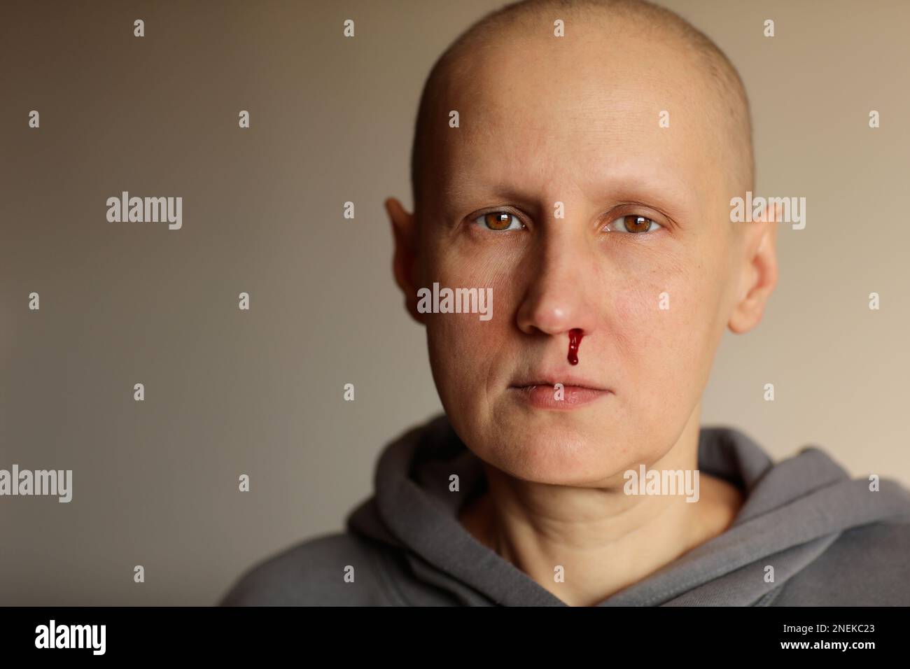 Young bald cancer sick woman is bleeding from her nose, effects of ...