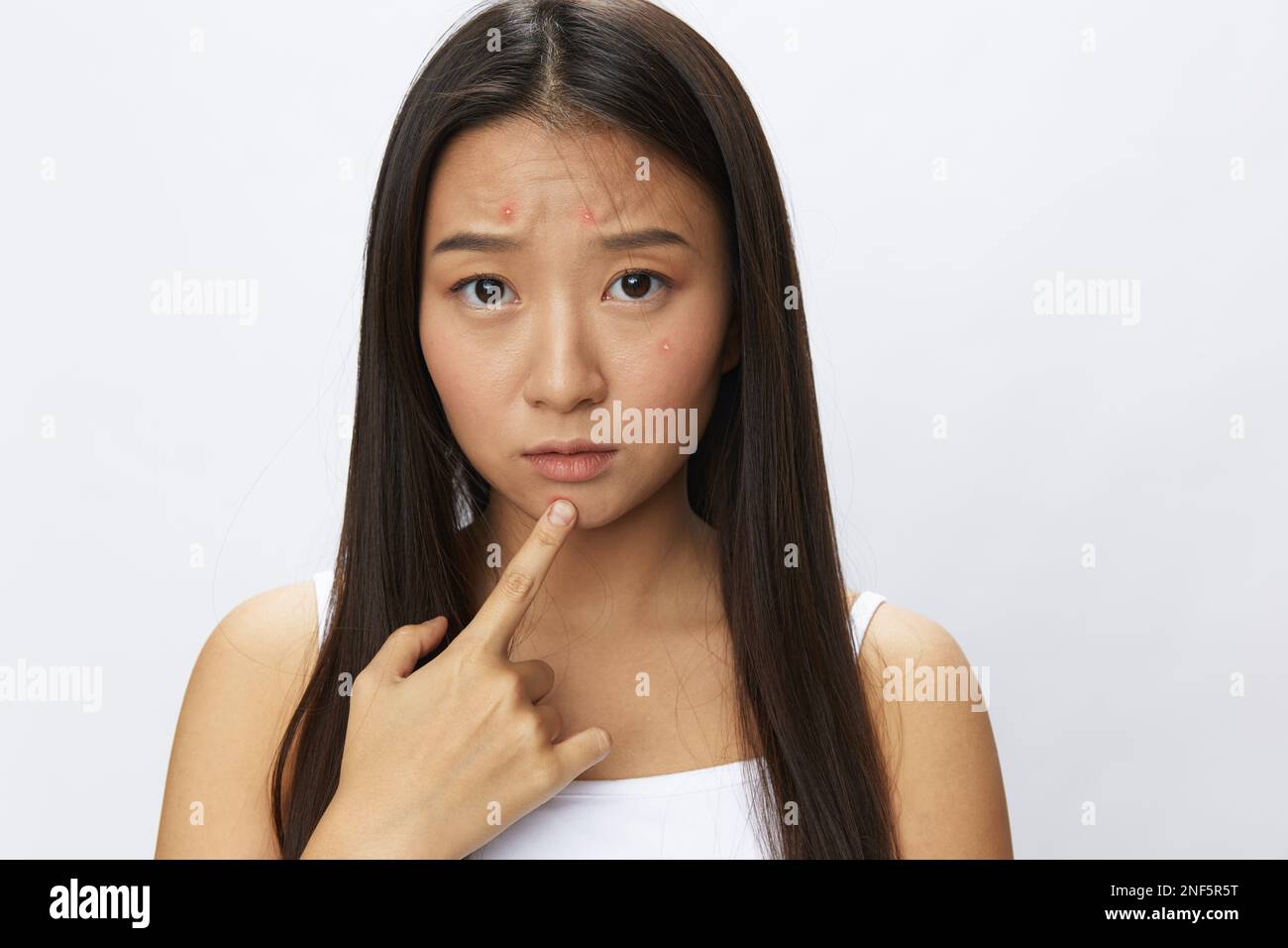 Asian woman facial skin problems, acne and inflammation, red rashes and ...