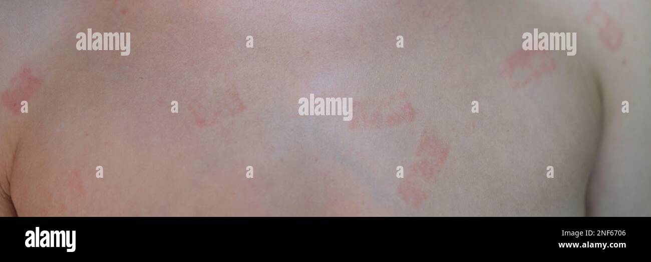 Red itchy patch rash on woman skin closeup Stock Photo - Alamy