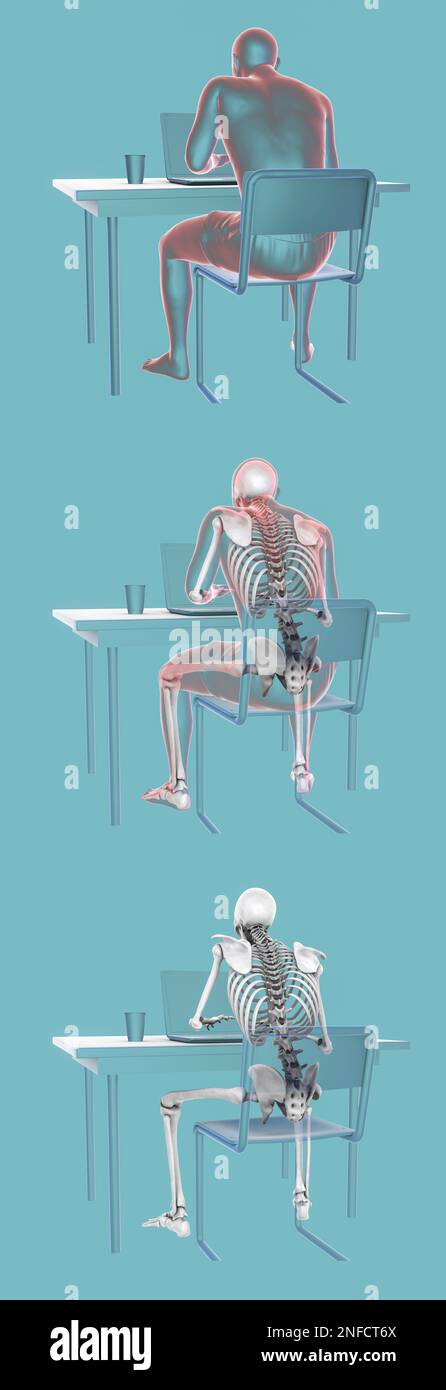 Working with laptop in a wrong position. Concept of back pain. Computer ...