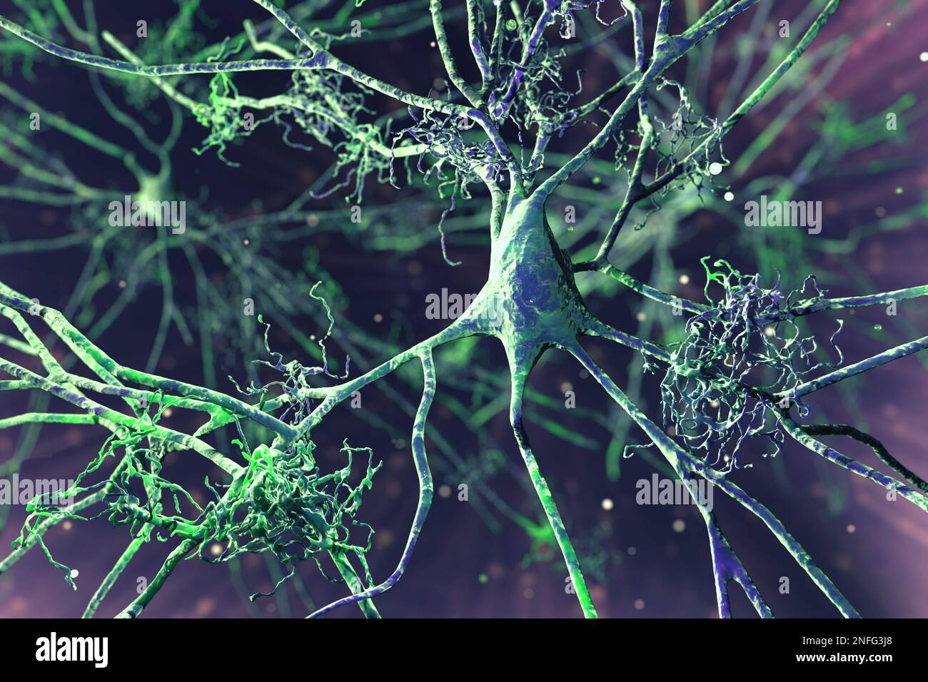 Alzheimer's disease plaques hi-res stock photography and images - Alamy