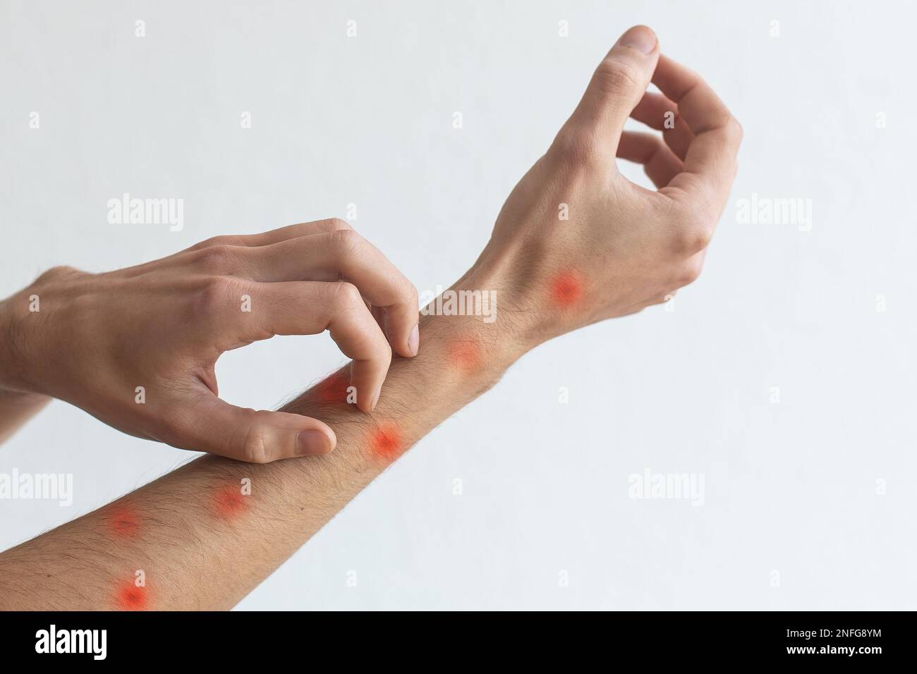 ill allergic rash dermatitis eczema skin of patient Stock Photo - Alamy