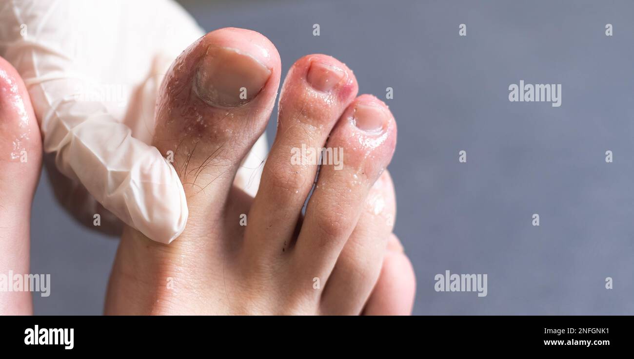 A white man holding his toes, showing what looks like a rash with red ...