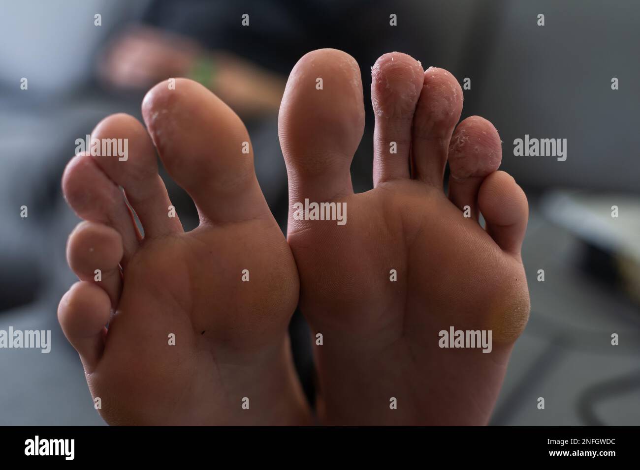 A man's toes showing what looks like a rash with red blotchy skin. A ...