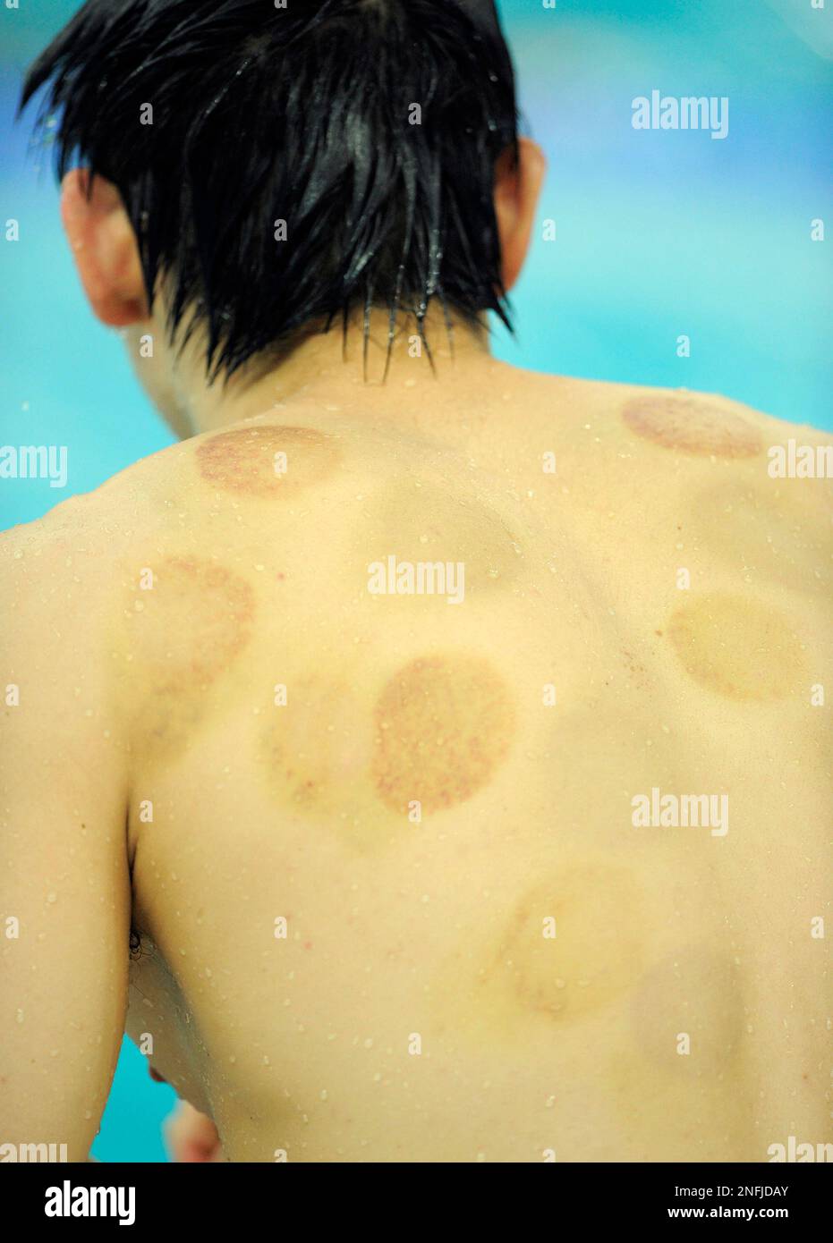 A Chinese diver shows marks of cupping session during a training ...
