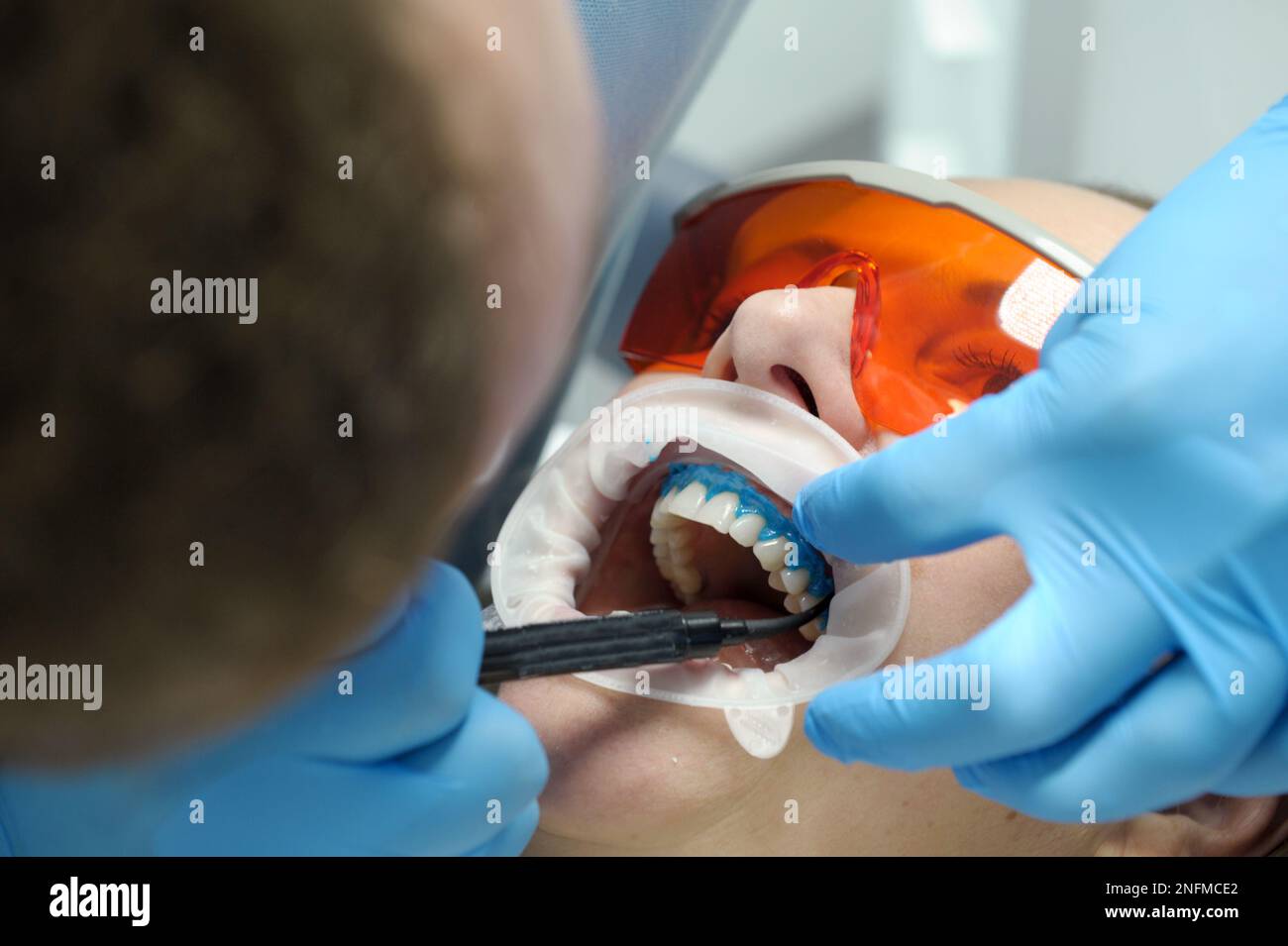 liquid cofferdam to isolate the gums from action of a bleaching agent ...