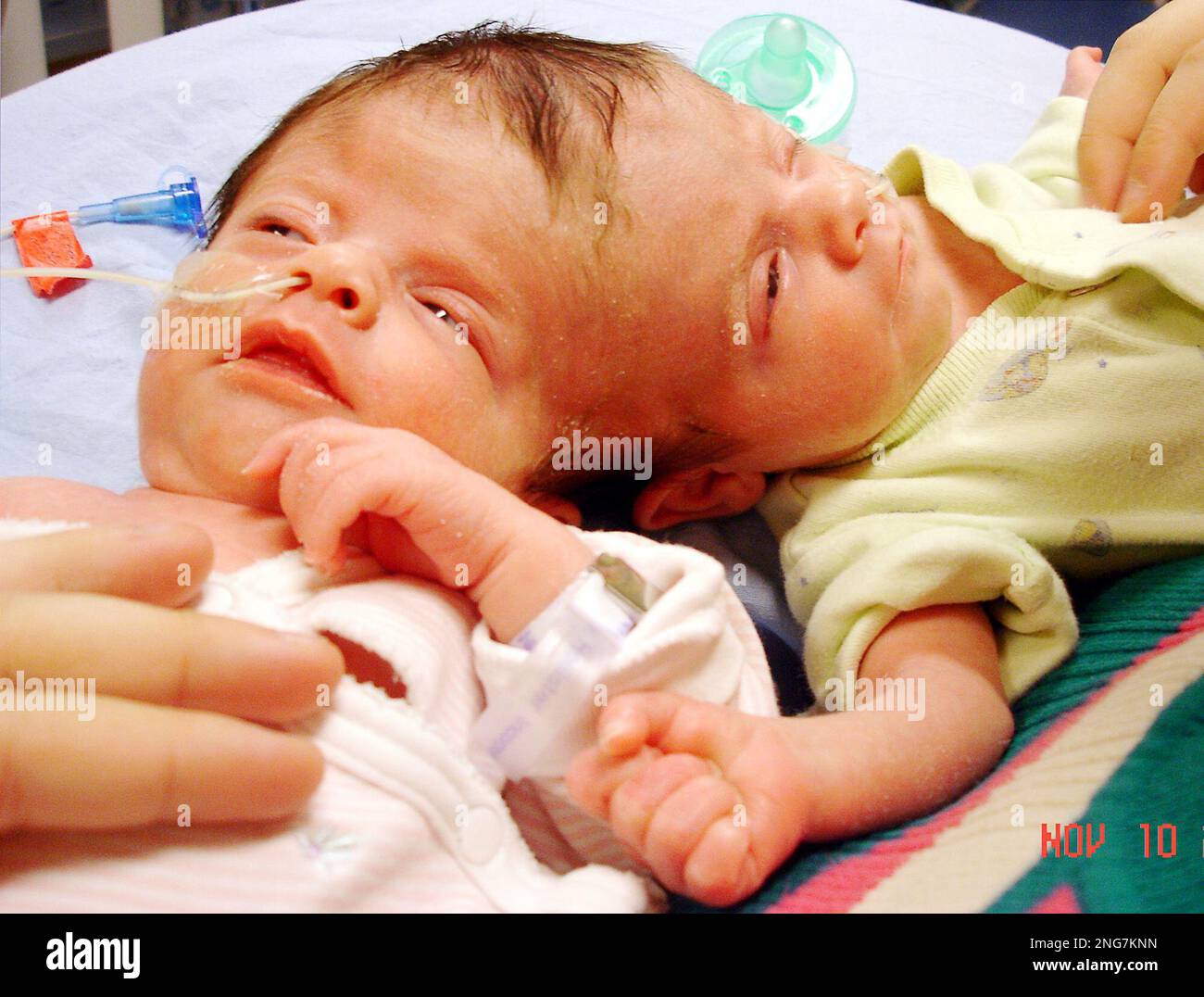 Felicia Simms visits with her conjoined twins Tatiana, left, and Krista ...