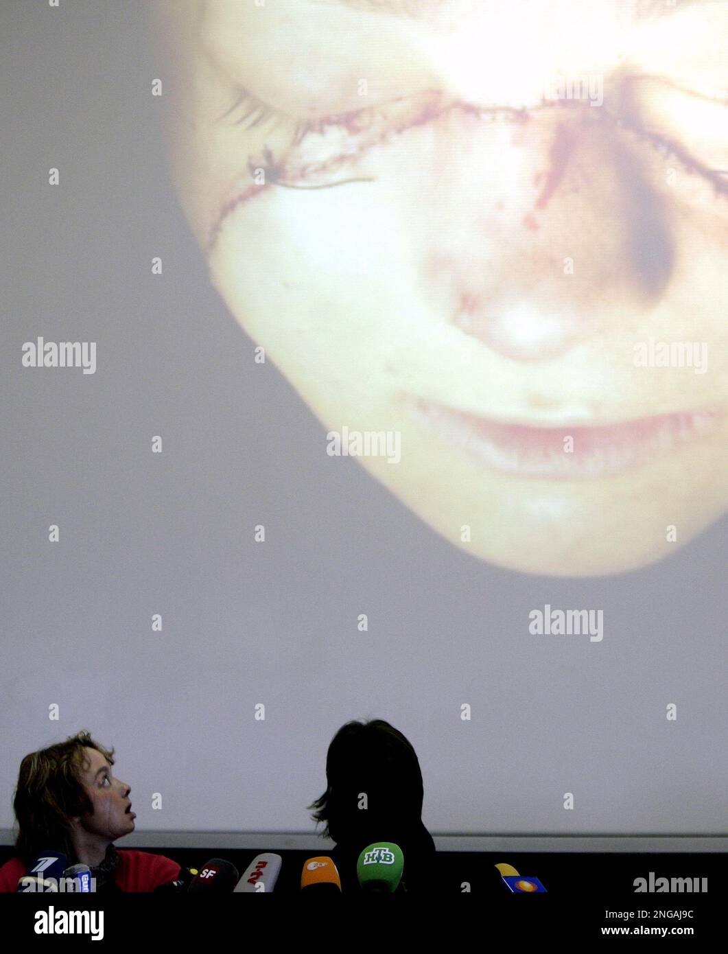 Isabelle Dinoire, left, the woman who received the world's first ...