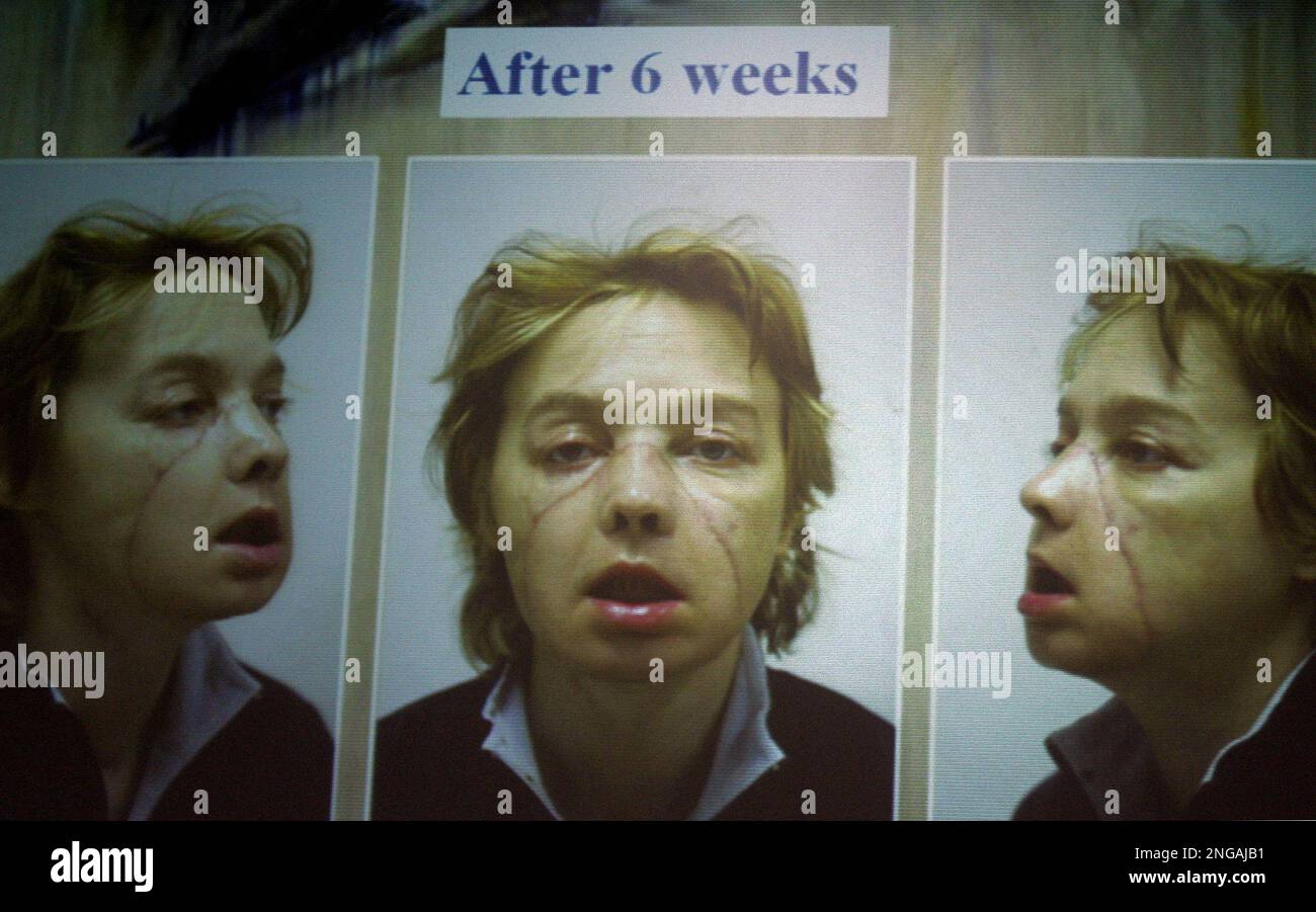 The photos of Isabelle Dinoire, the woman who received the world's ...
