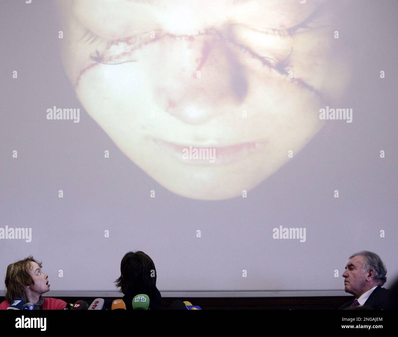 Isabelle Dinoire, left, the woman who received the world's first ...