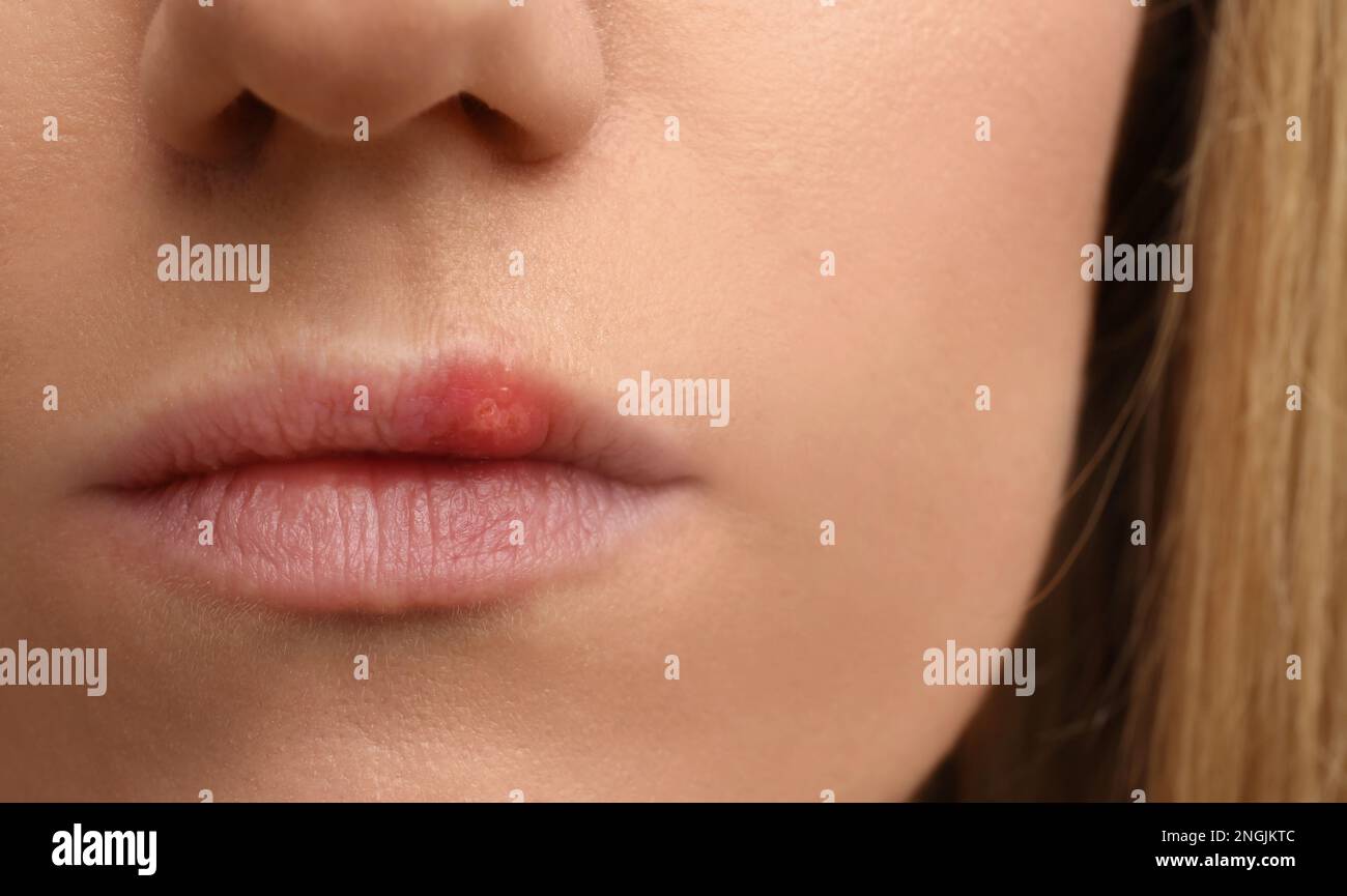 Woman suffering from herpes, closeup. Dermatological problem Stock ...