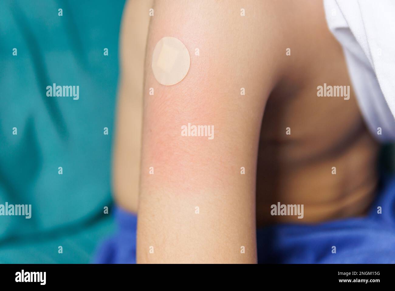 Local reaction to vaccine in children Stock Photo - Alamy