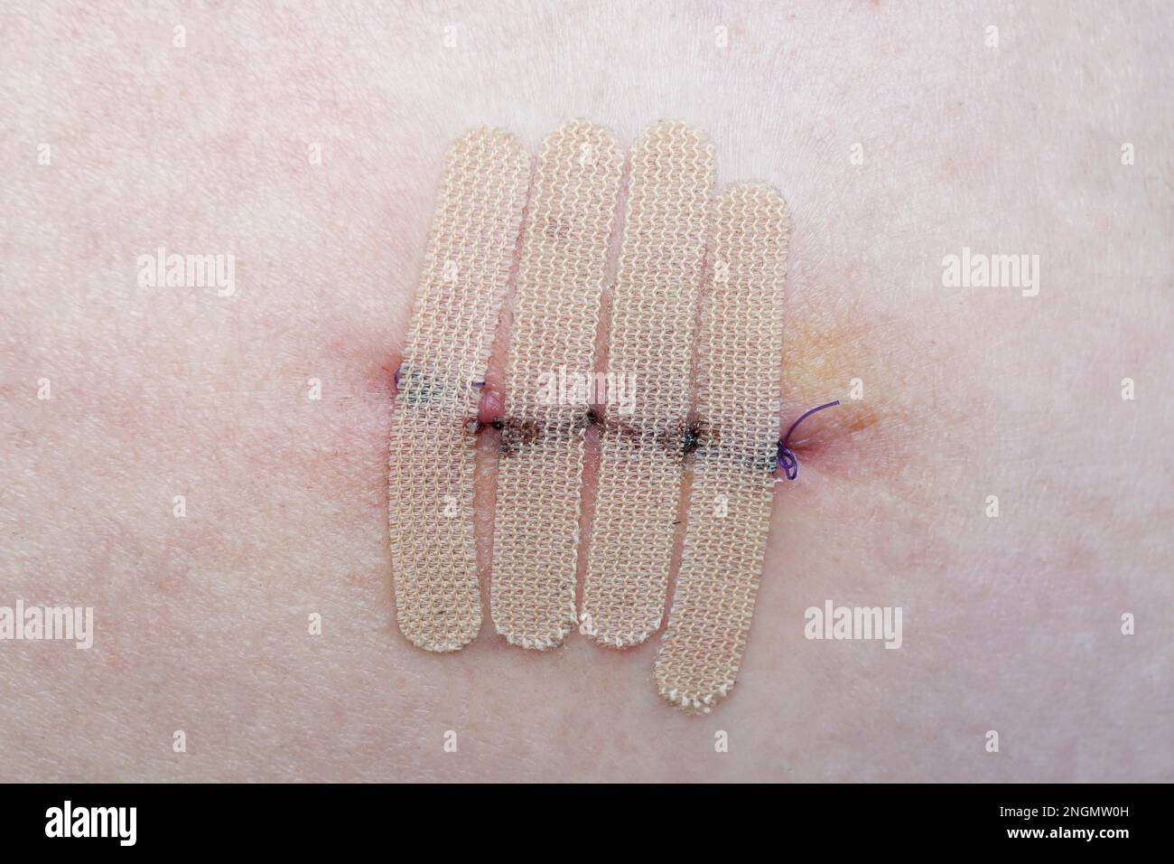 close-up of human skin with suture and wound closure strips or surgical ...