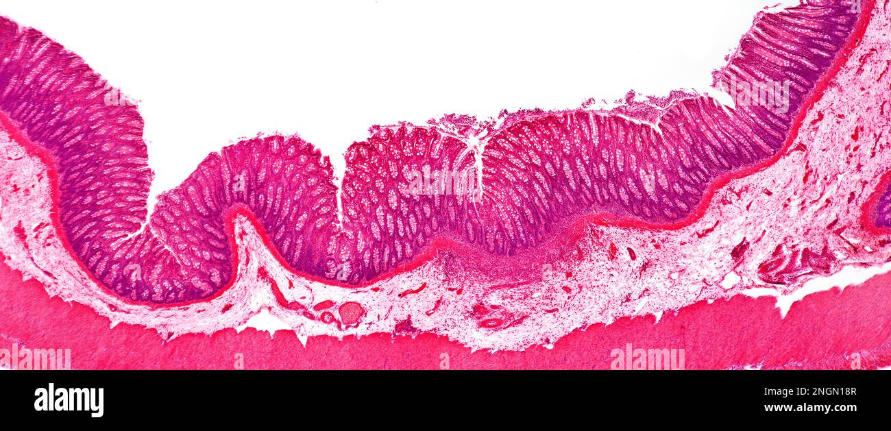 Human appendix section, vermiform appendix Stock Photo - Alamy Human appendix section, vermiform appendix Stock Photo - Alamy