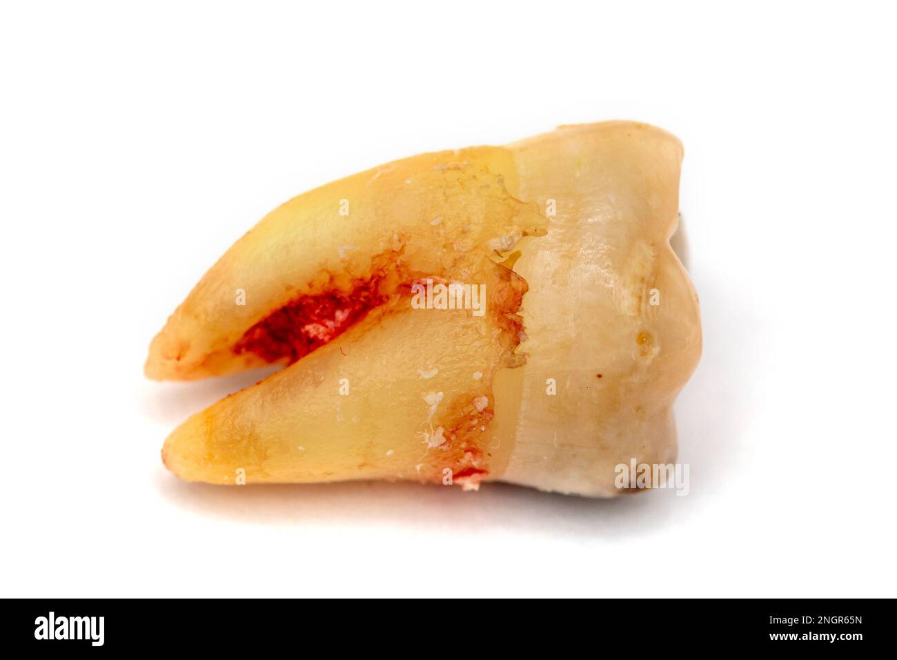 Molar tooth decay hi-res stock photography and images - Alamy