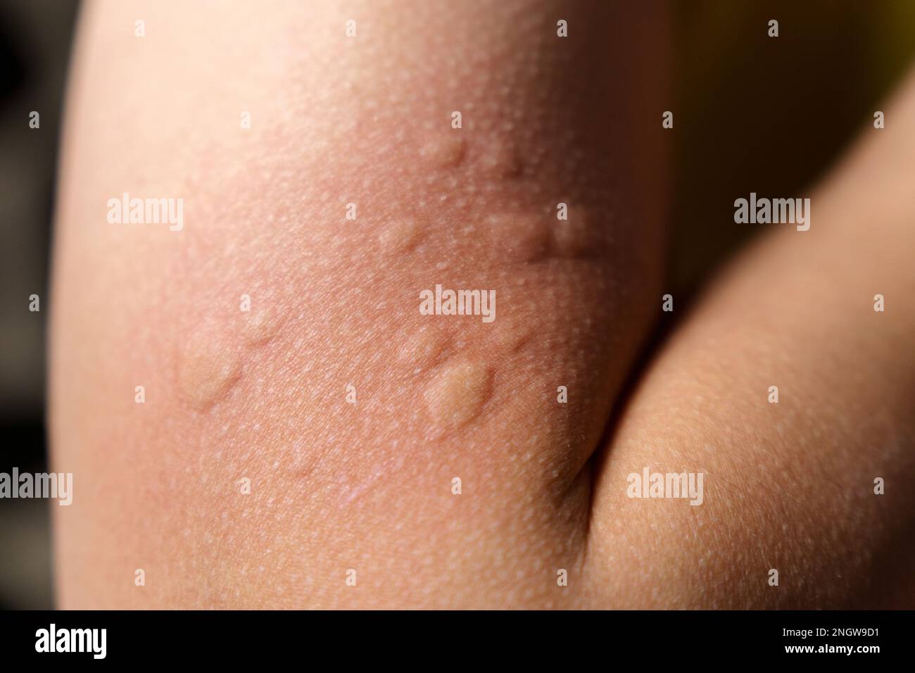 Injection site reaction hi-res stock photography and images - Alamy