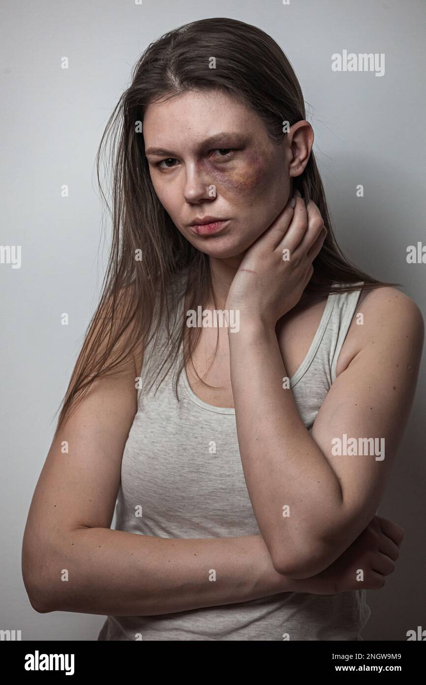 Domestic violence, abuse woman with bruise on face Stock Photo - Alamy