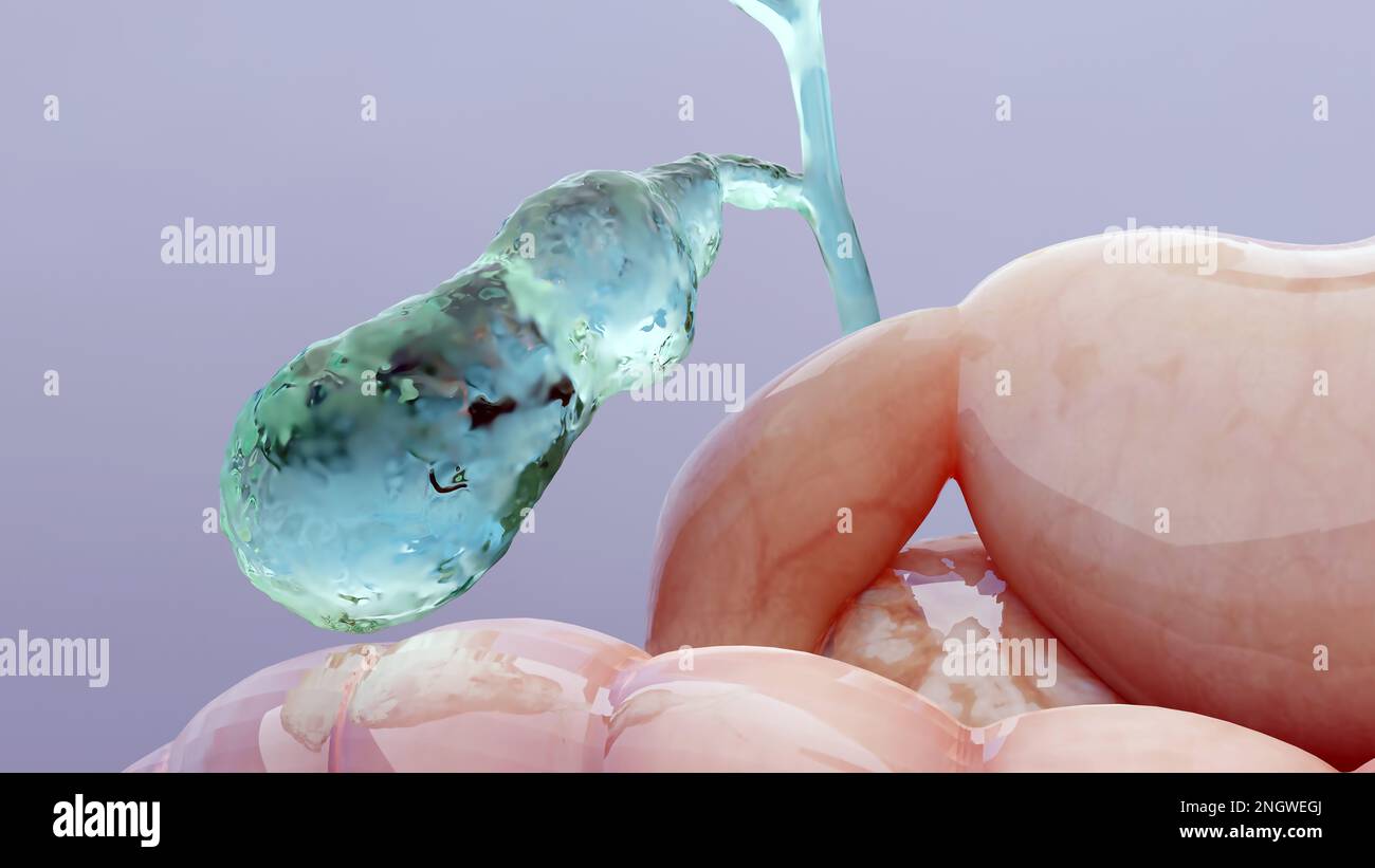Gallstones In The Gallbladderand Bile Duct Human Silhouette And Anatomy Of Surrounding Organs