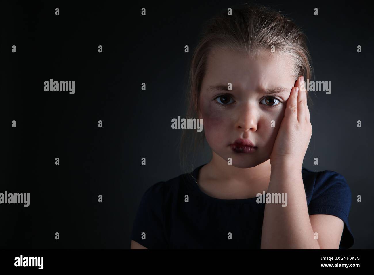 Little girl with bruises on face against dark background, space for ...