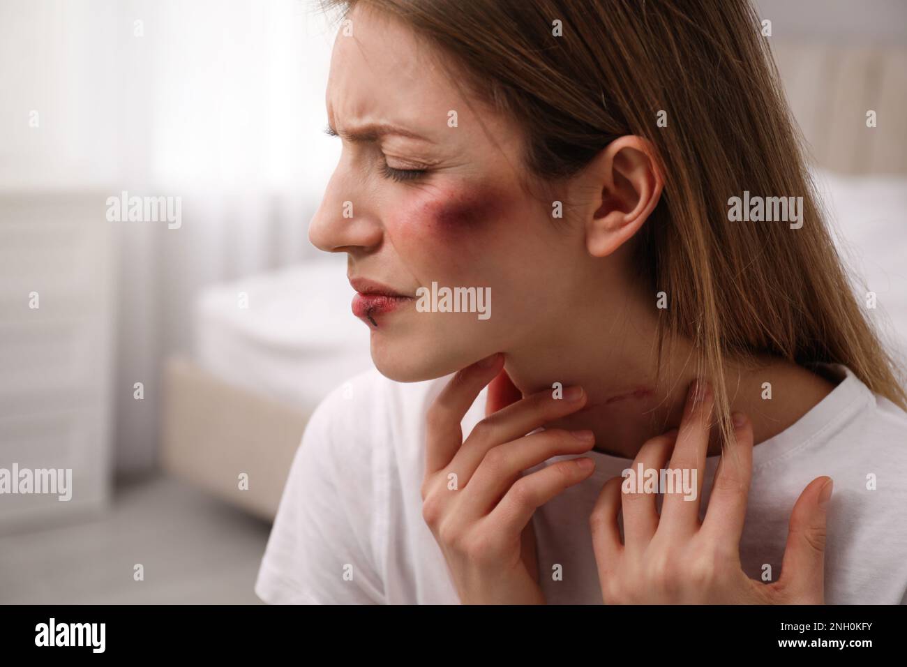 Woman with facial injuries in bedroom. Domestic violence victim Stock ...