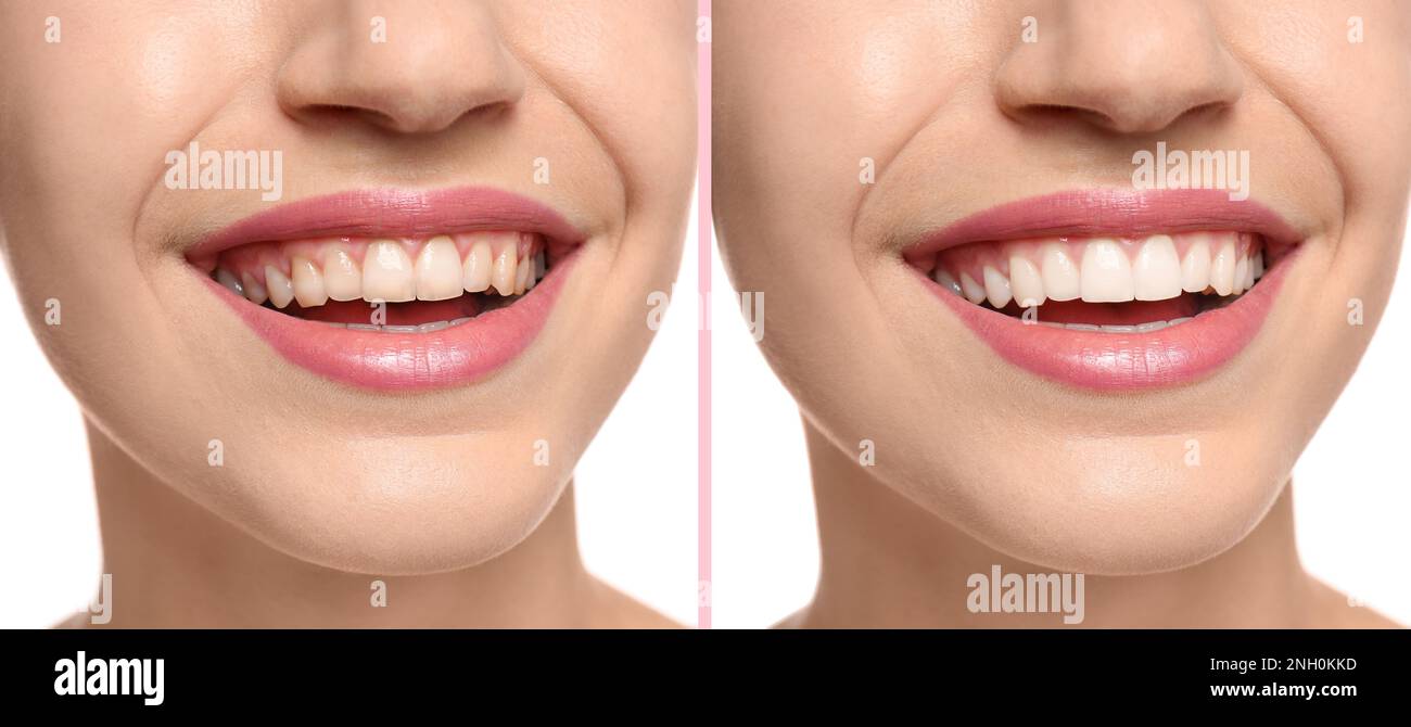 Collage with photos of woman before and after teeth whitening, closeup ...