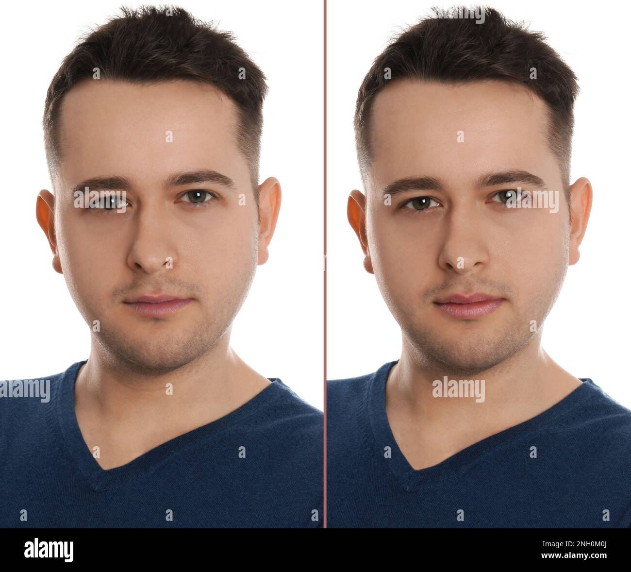 Collage with photos of man before and after lips augmentation Stock ...