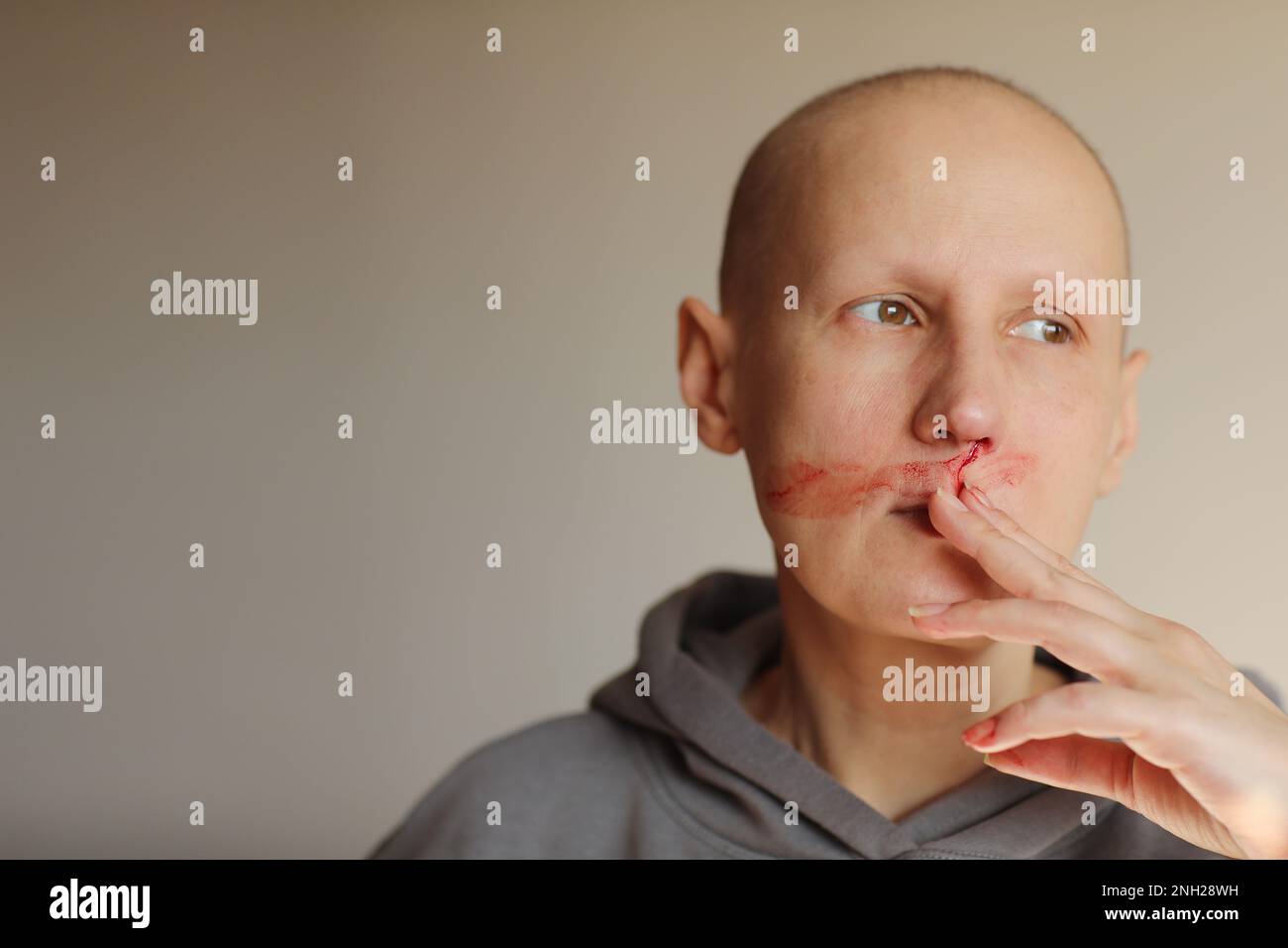 Hairless cancer sick female patient is bleeding from her nose, effects ...