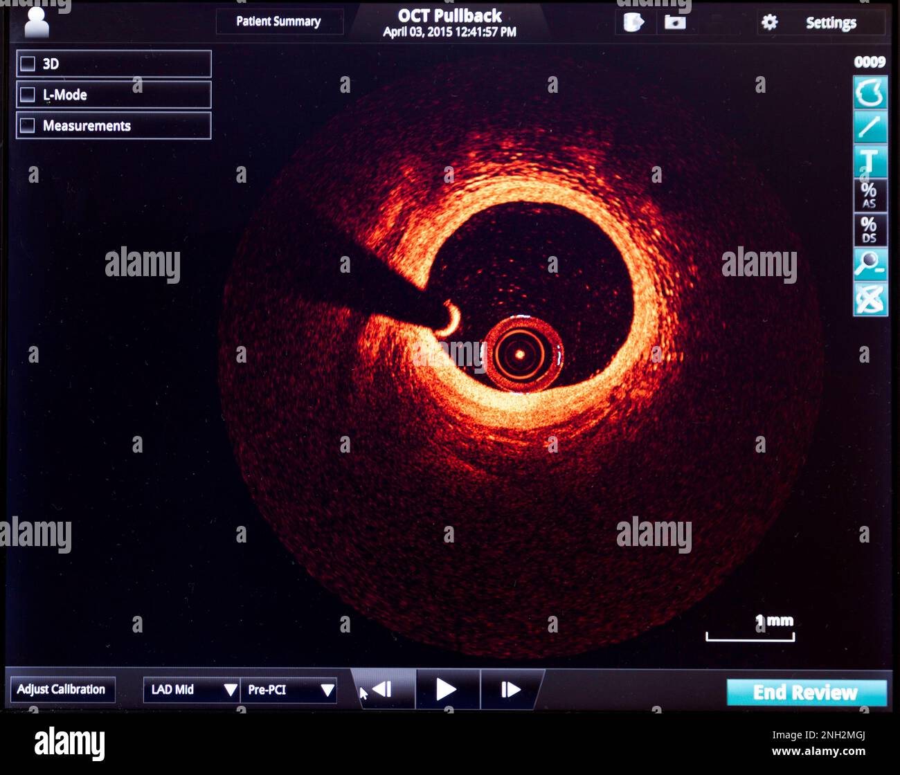 Optical coherence tomography (oct) hi-res stock photography and images ...