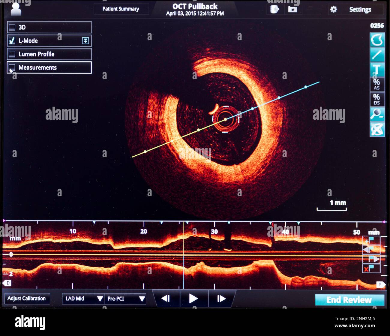 Optical coherence tomography (oct) hi-res stock photography and images ...