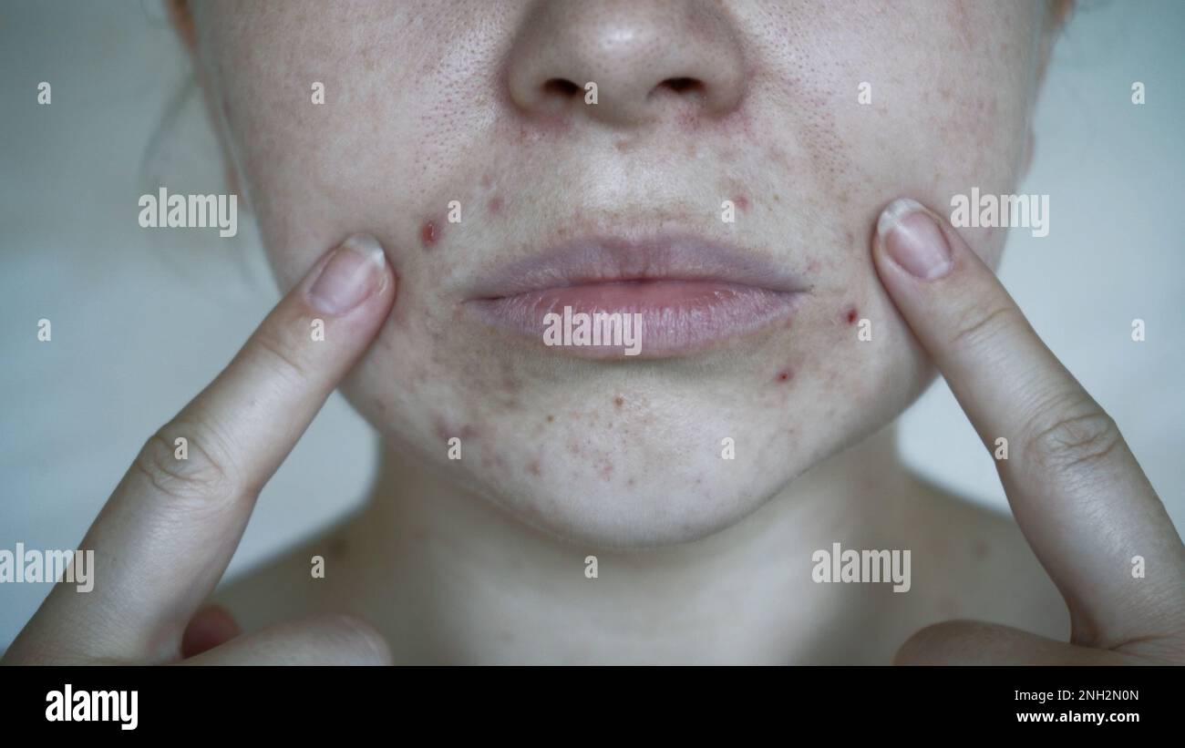 Close up of skin problems, unhealthy skin with acne and pimples. Porous ...